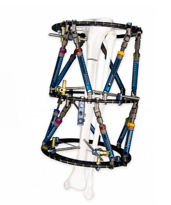 Tibia external fixation system - Smart Correction® - WishBone Medical ...