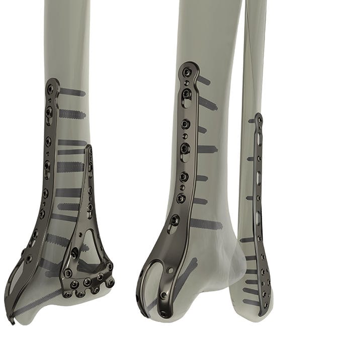 Tibia compression plate - STEP® - WishBone Medical - fibula / malleolus ...