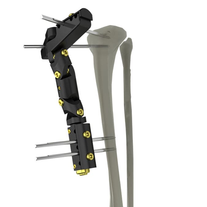 Tibia external fixation system - UniX® - WishBone Medical - femur ...