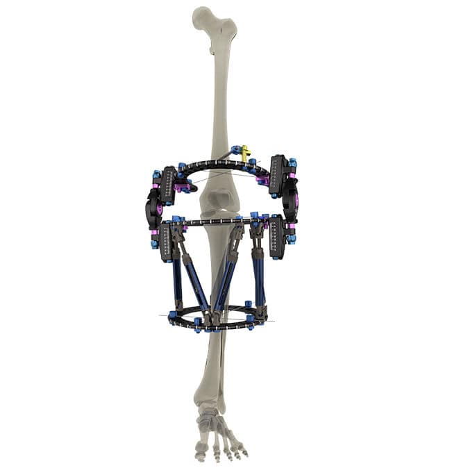 Knee external fixation system - WishBone Medical - circular / adult