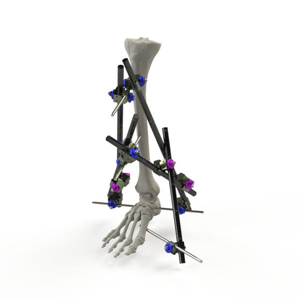 Modular external fixation system - TASARIMMED - tibia / ankle / elbow