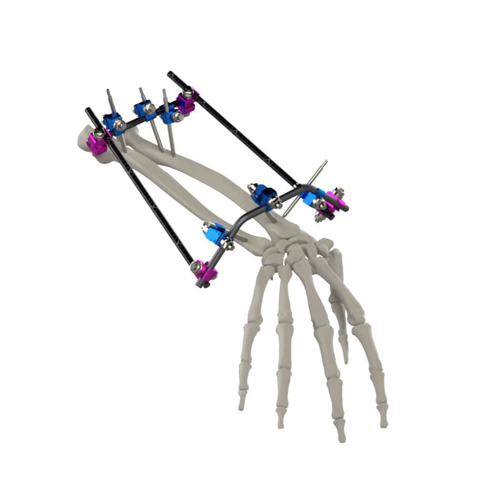 Elbow external fixation system - TF-TUBU Small Fix - TASARIMMED - wrist ...
