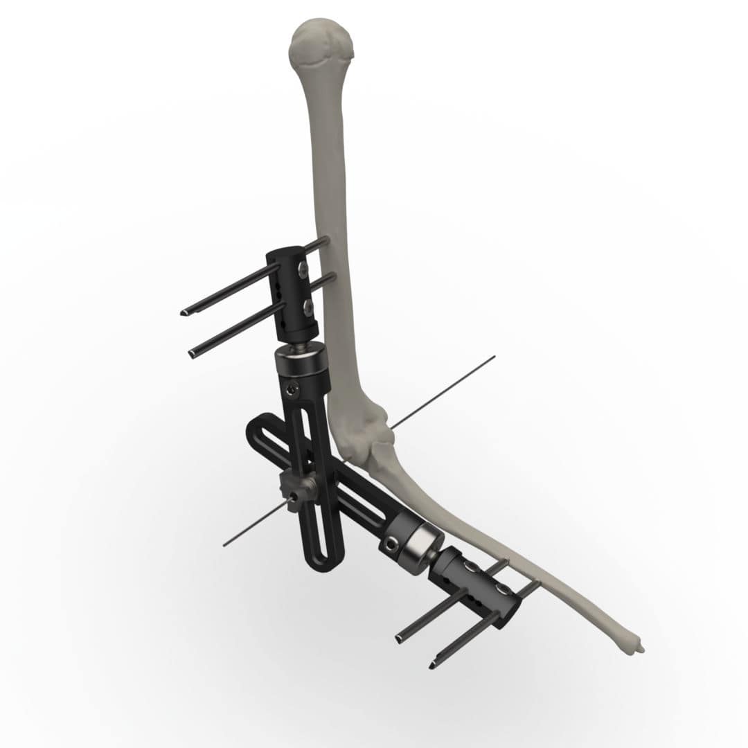 Elbow external fixation system - TF-8000-1 - TASARIMMED - tubular / adult