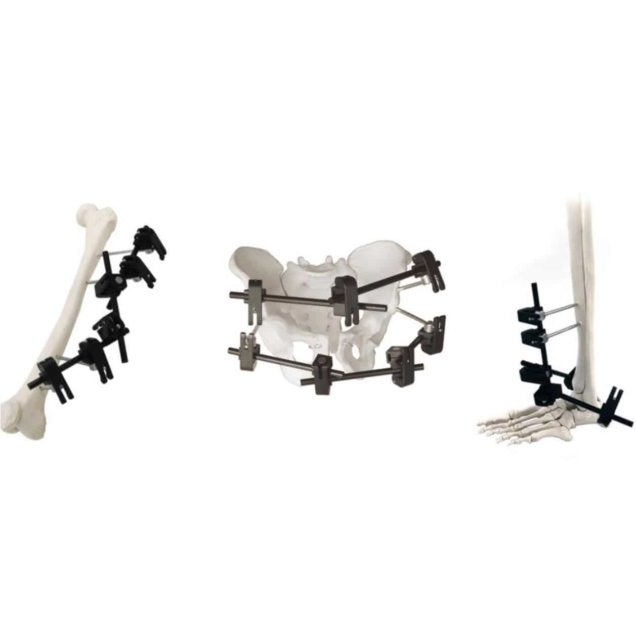 Modular external fixation system - QuickX - Zhejiang Borumon Biological ...