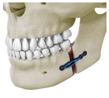 Mandible osteotomy plate - Delphos Implants - metallic