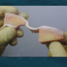 Peroneus longus tendon ligament prosthesis - CenoBiologics - patellar ...