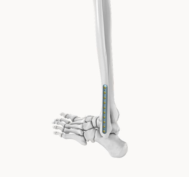Fibula compression plate - EDF 010 - Eonex Medical - distal / locking ...