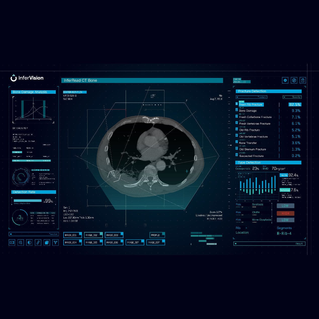 Analysis software - Bone - Beijing Infervision Technology Co. Ltd ...