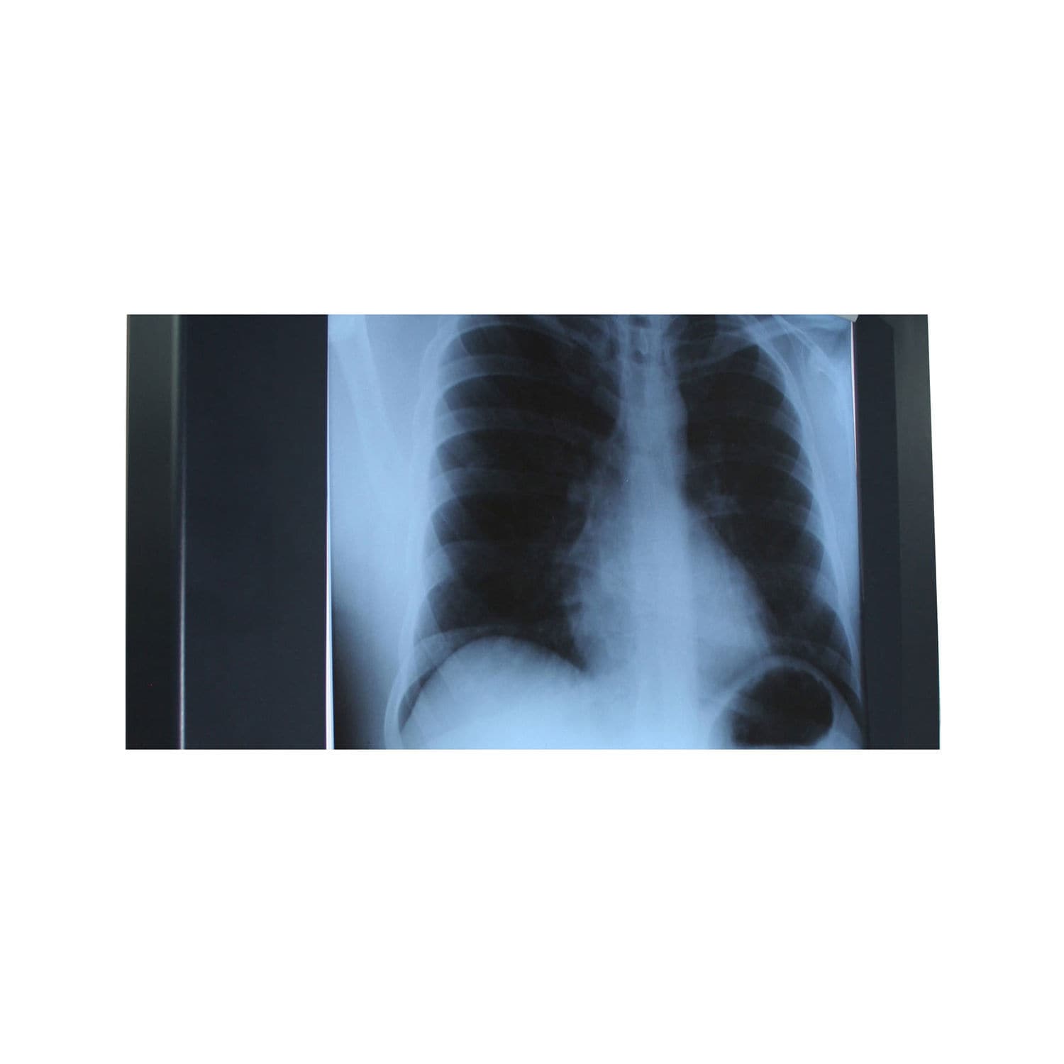 1-screen X-ray film viewer - Woodmans Meditech - LED