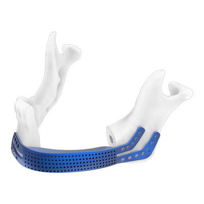 Mandible compression plate - Osteophoenix - maxillofacial / titanium