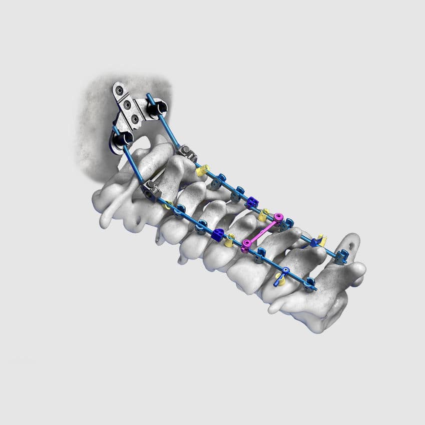 Occipito-cervical osteosynthesis unit - Wuxi Betta Medical Technology ...