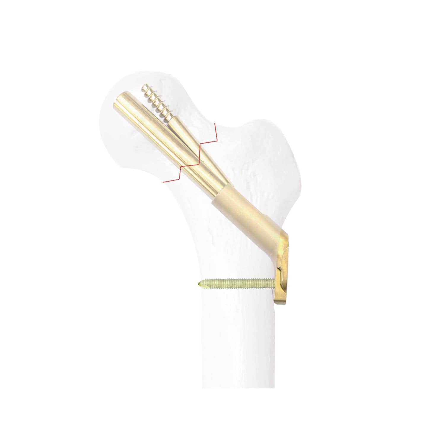 Femoral head compression plate - 33506 - Kangli Medical - locking ...