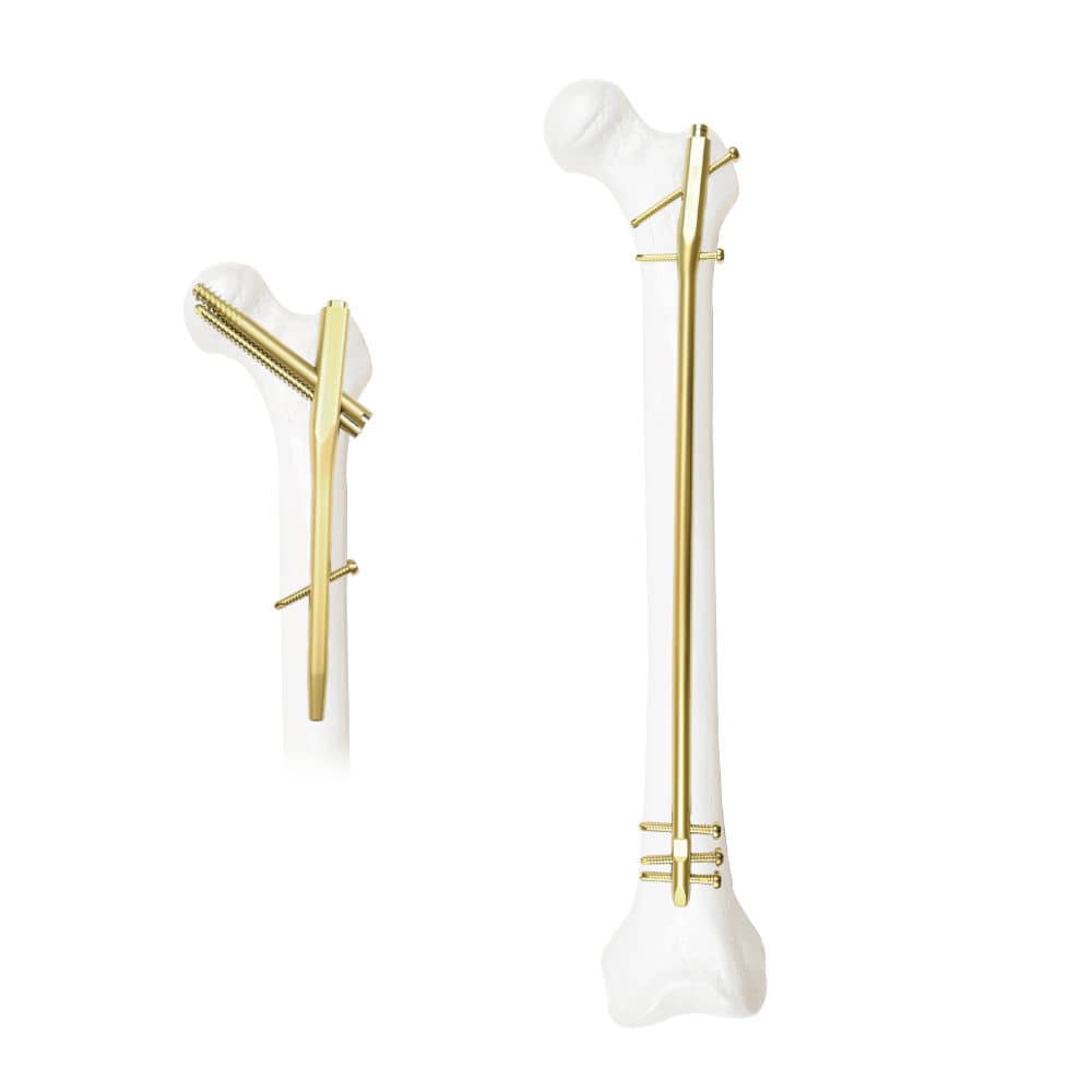 Femoral intramedullary nail - KTO - Kangli Medical - trochanter ...