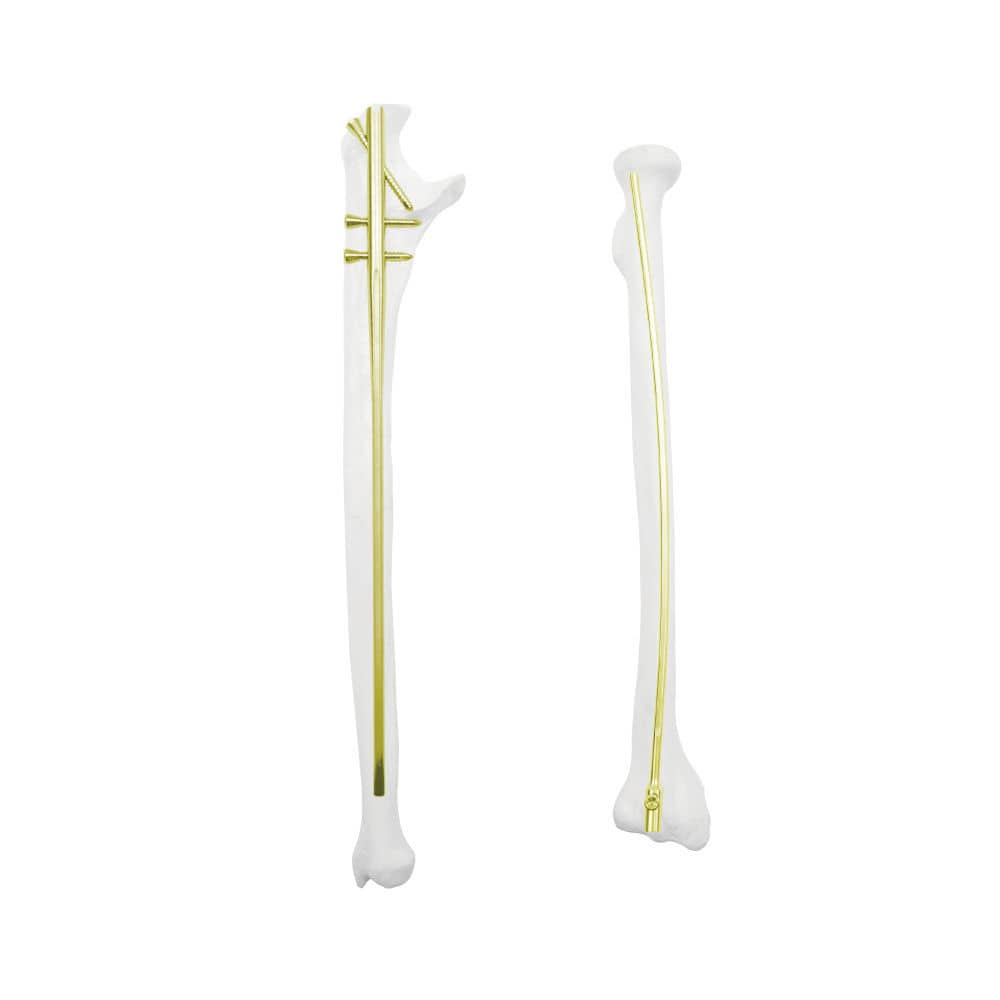 Radius intramedullary nail - QML - Kangli Medical - ulna / proximal ...