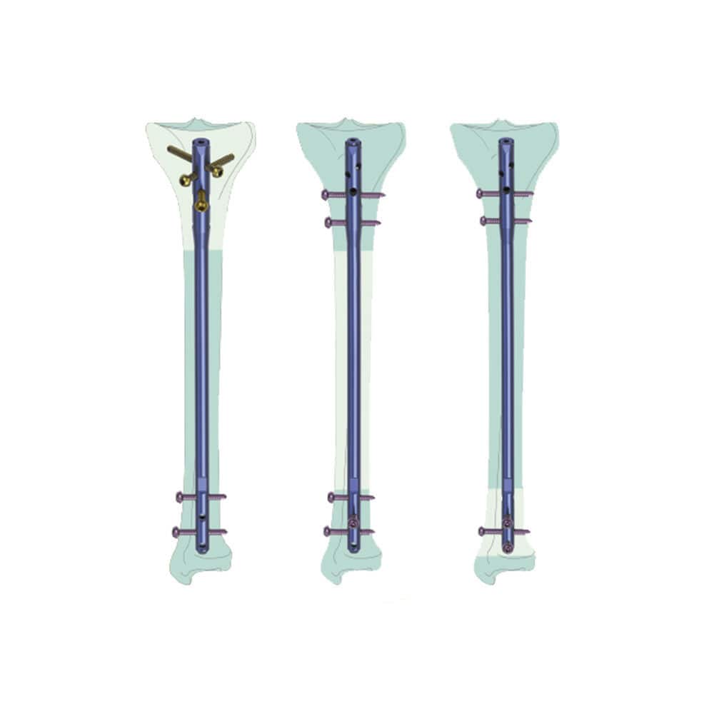 Tibial intramedullary nail - KTO - Suzhou Kangli Orthopaedics ...