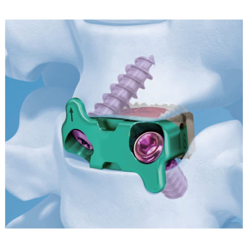 Cervical interbody fusion cage - G-58020 - Kangli Medical - anterior / PEEK
