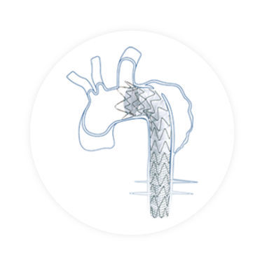 Ascending thoracic aorta stent graft - Talos™ - Endovastec - nitinol