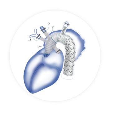 Aortic arch stent graft - Fontus™ - Endovastec - nitinol / polyethylene