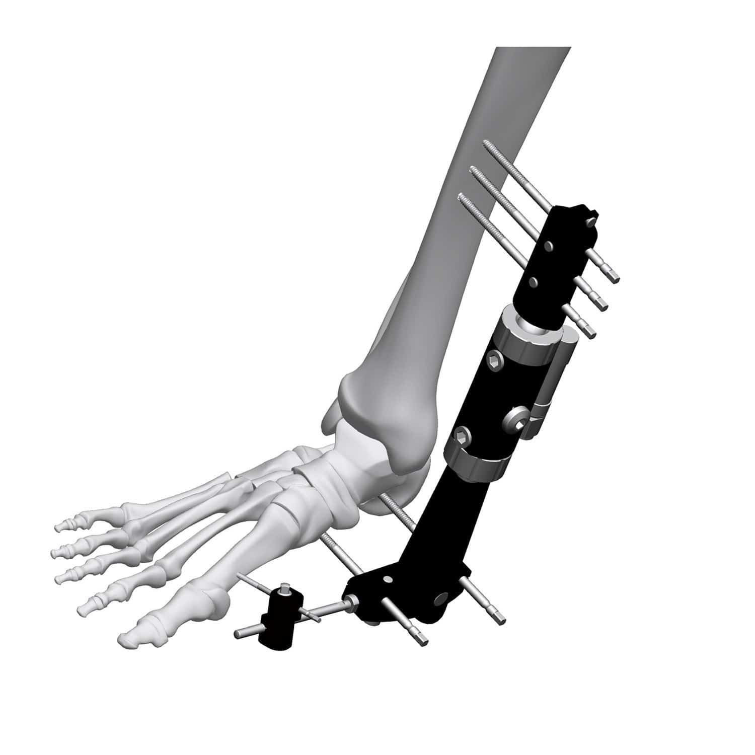 Ankle external fixation system - FE8M-D050 - Chongqing FWS Medical ...