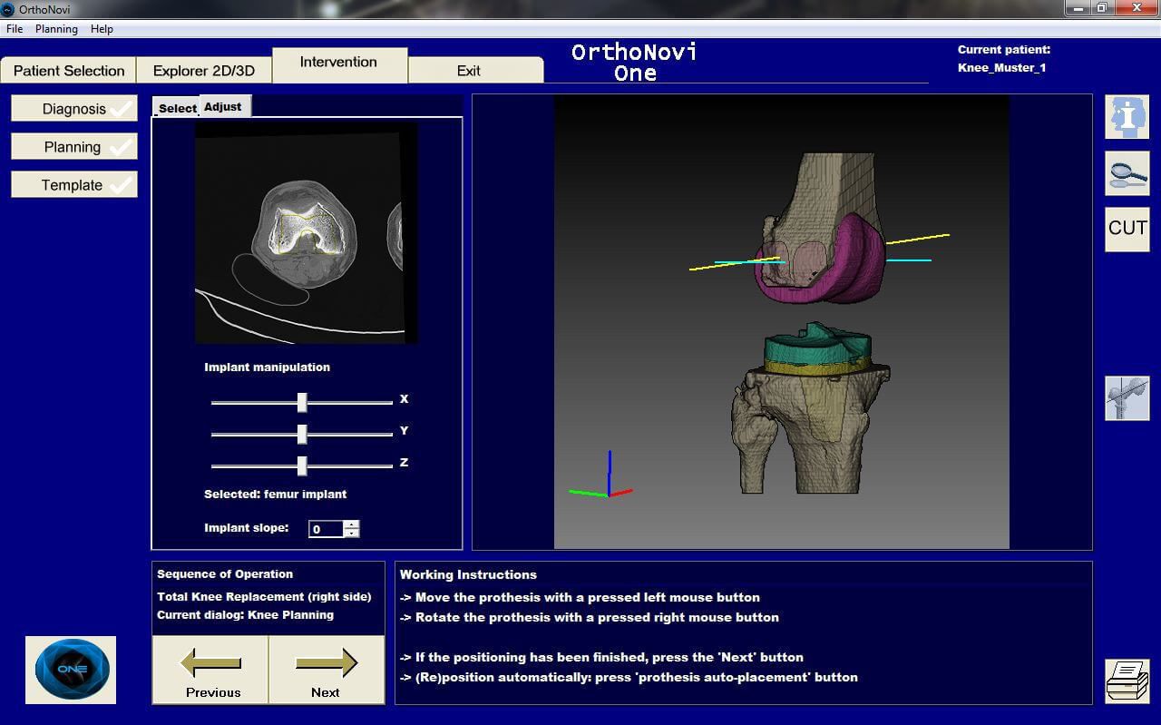 Planning software - OrthoNovi - SurgiNovi - preoperative planning ...