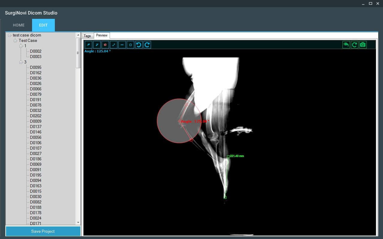 DICOM viewing software - SurgiNovi Studio - SurgiNovi - measurement / data processing / medical