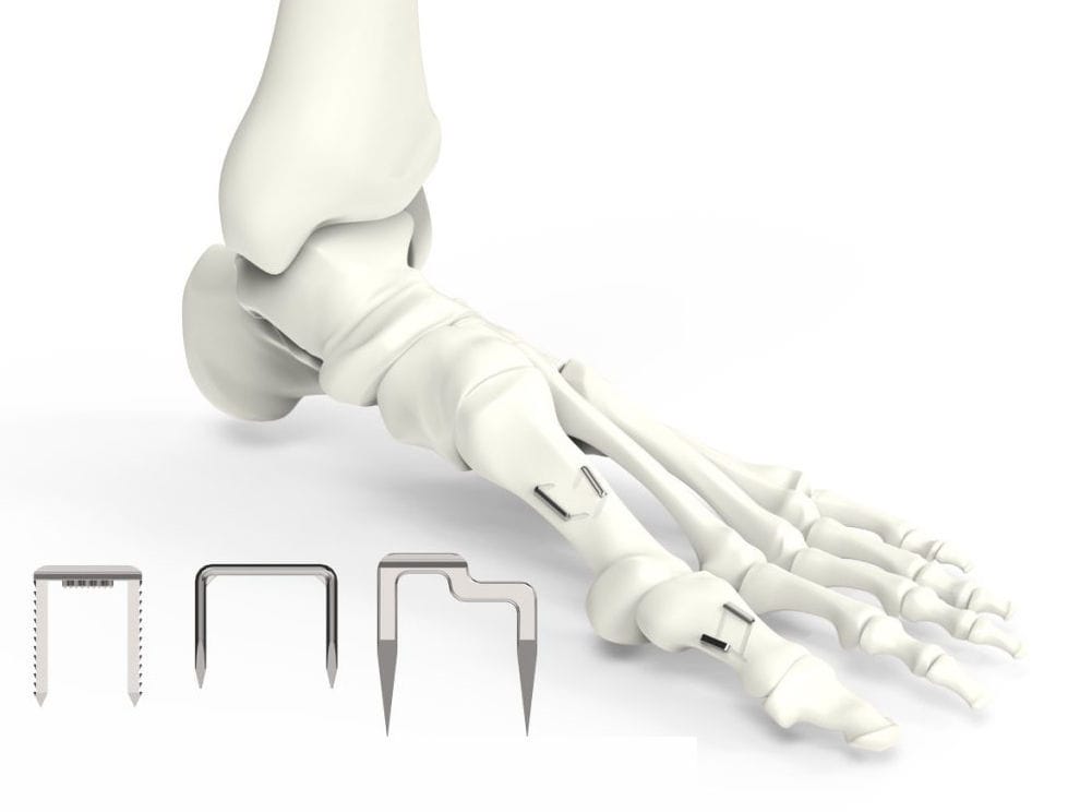 Forefoot bone staple - TST Othopedics - non-absorbable
