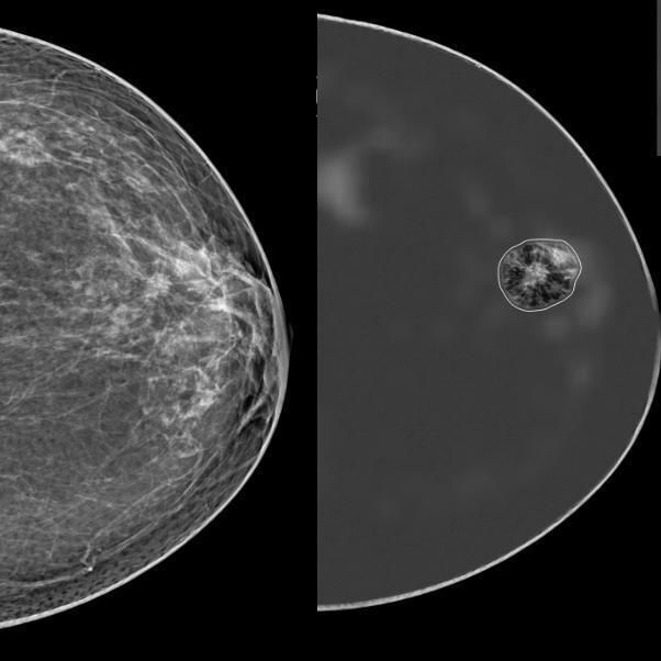 Analysis software - Breast-SlimView® - Hera-MI - diagnostic ...