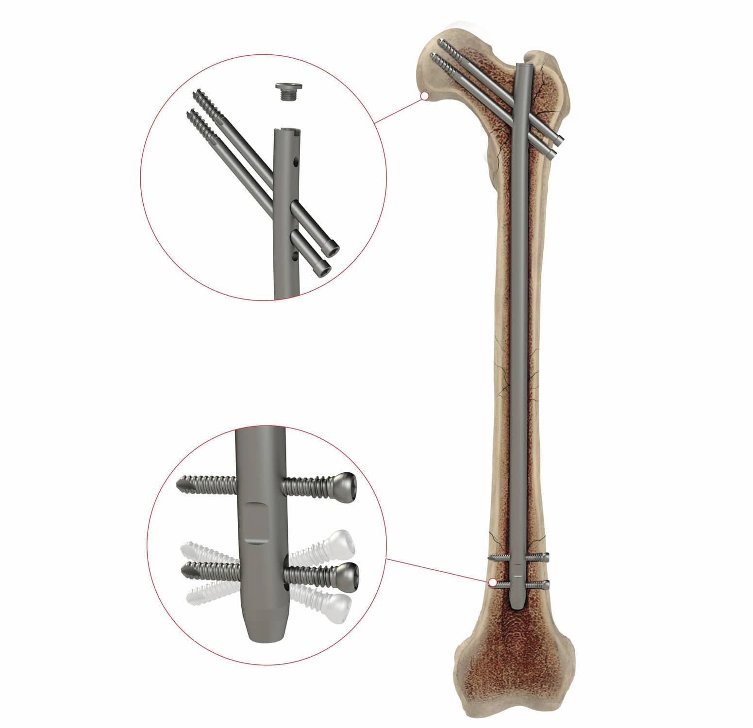 Femoral intramedullary nail - AS.AFN.400 - Ases Orthopedics - proximal ...