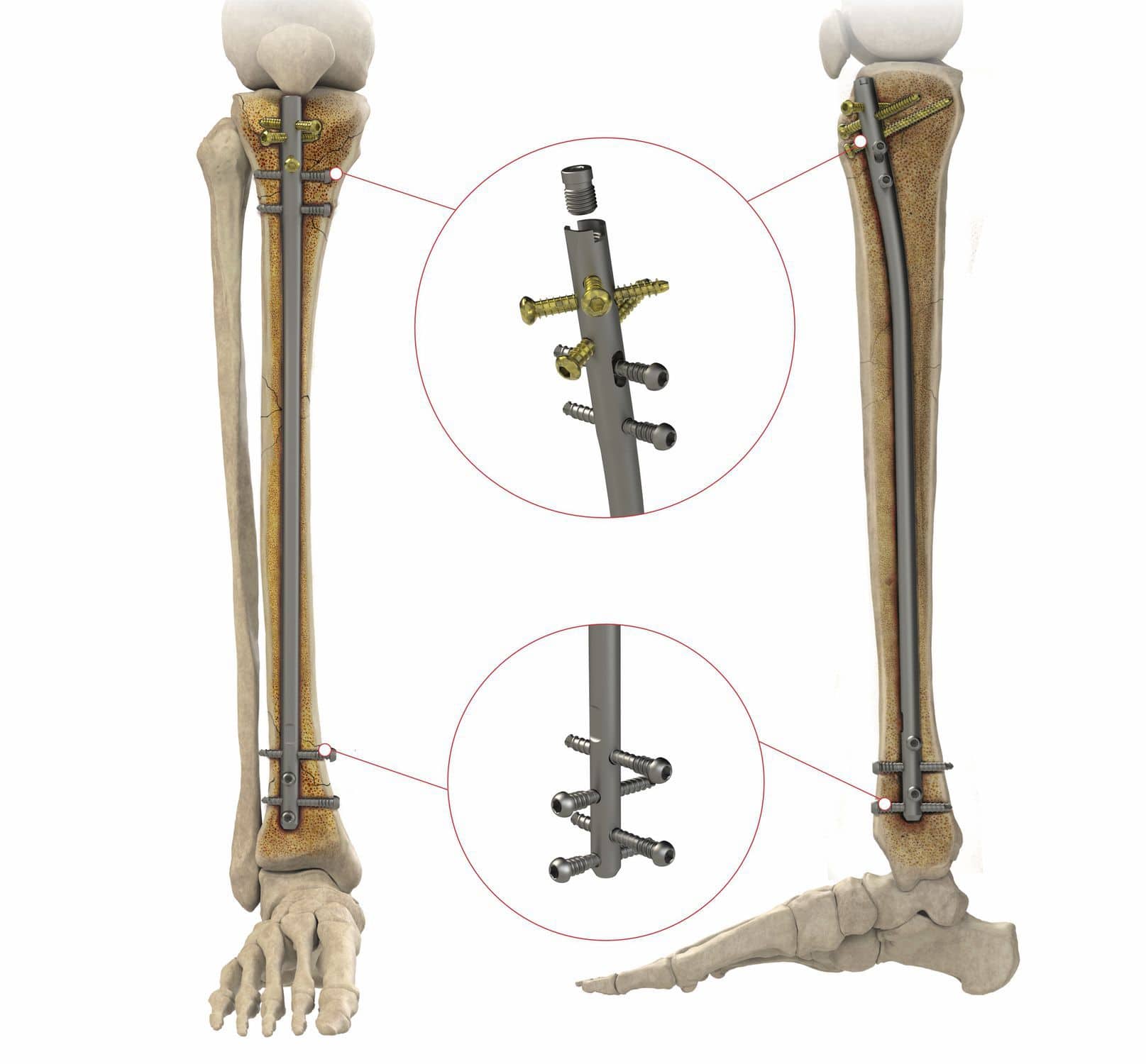 Tibial intramedullary nail - AS.ATN.401 - Ases Orthopedics - proximal fixation / distal fixation ...