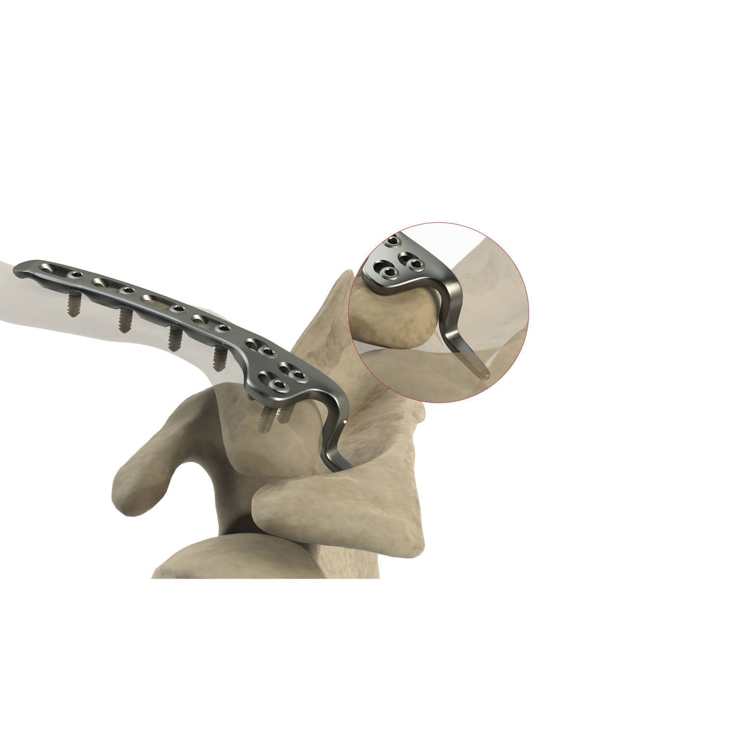 Clavicle Compression Plate As Sh 031 Ases Orthopedics Distal