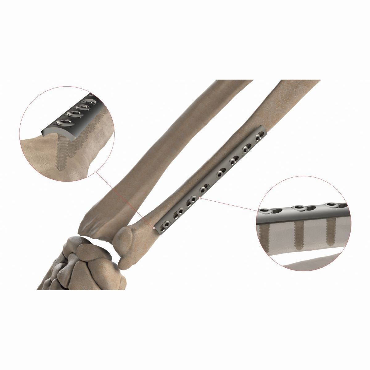 Radius compression plate - AS.ST.064 - Ases Orthopedics - ulna / mid ...