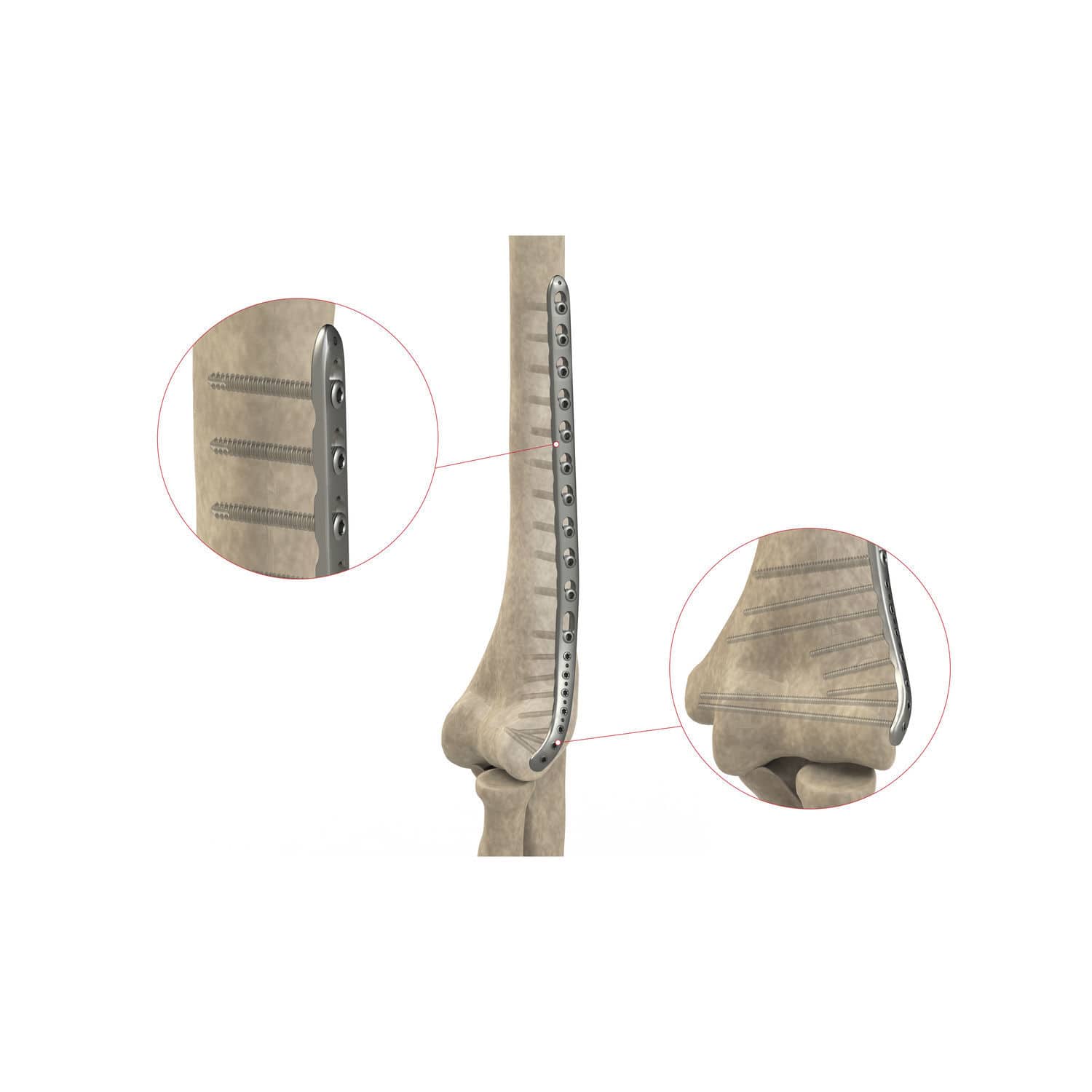 Humerus compression plate - AS.E.021 - Ases Orthopedics - distal ...