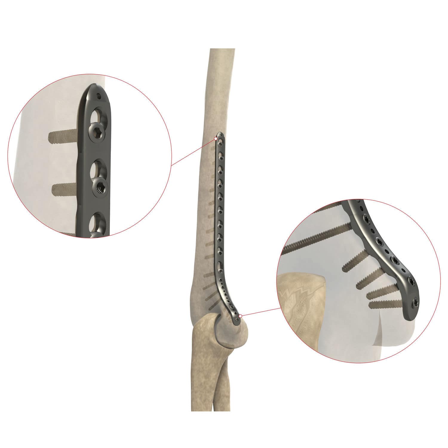 Humerus compression plate - AS.E.020 - Ases Orthopedics - distal ...