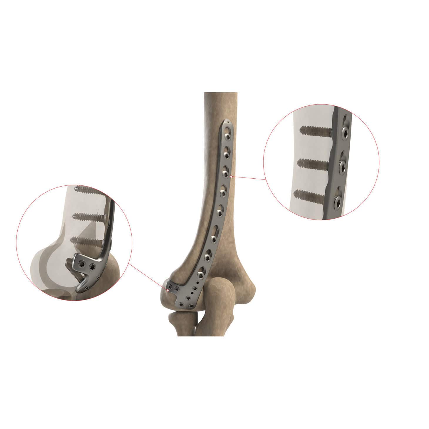 Humerus compression plate - AS.E.022 - Ases Orthopedics - distal ...