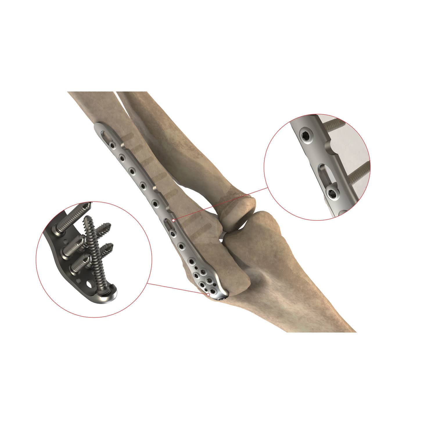 Humerus compression plate - AS.E.017 - Ases Orthopedics - distal ...