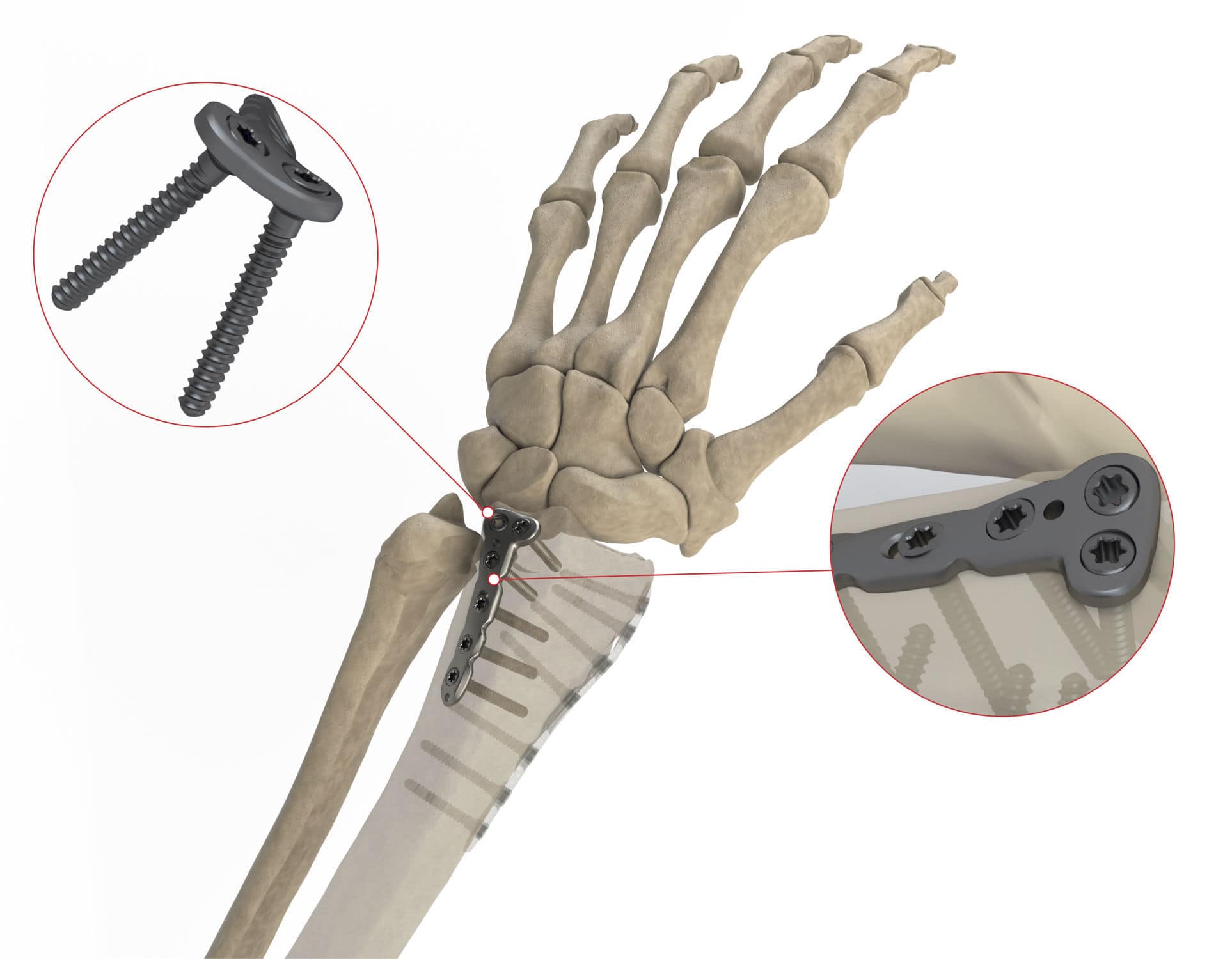 Radius compression plate - AS.W.014 - Ases Orthopedics - distal ...