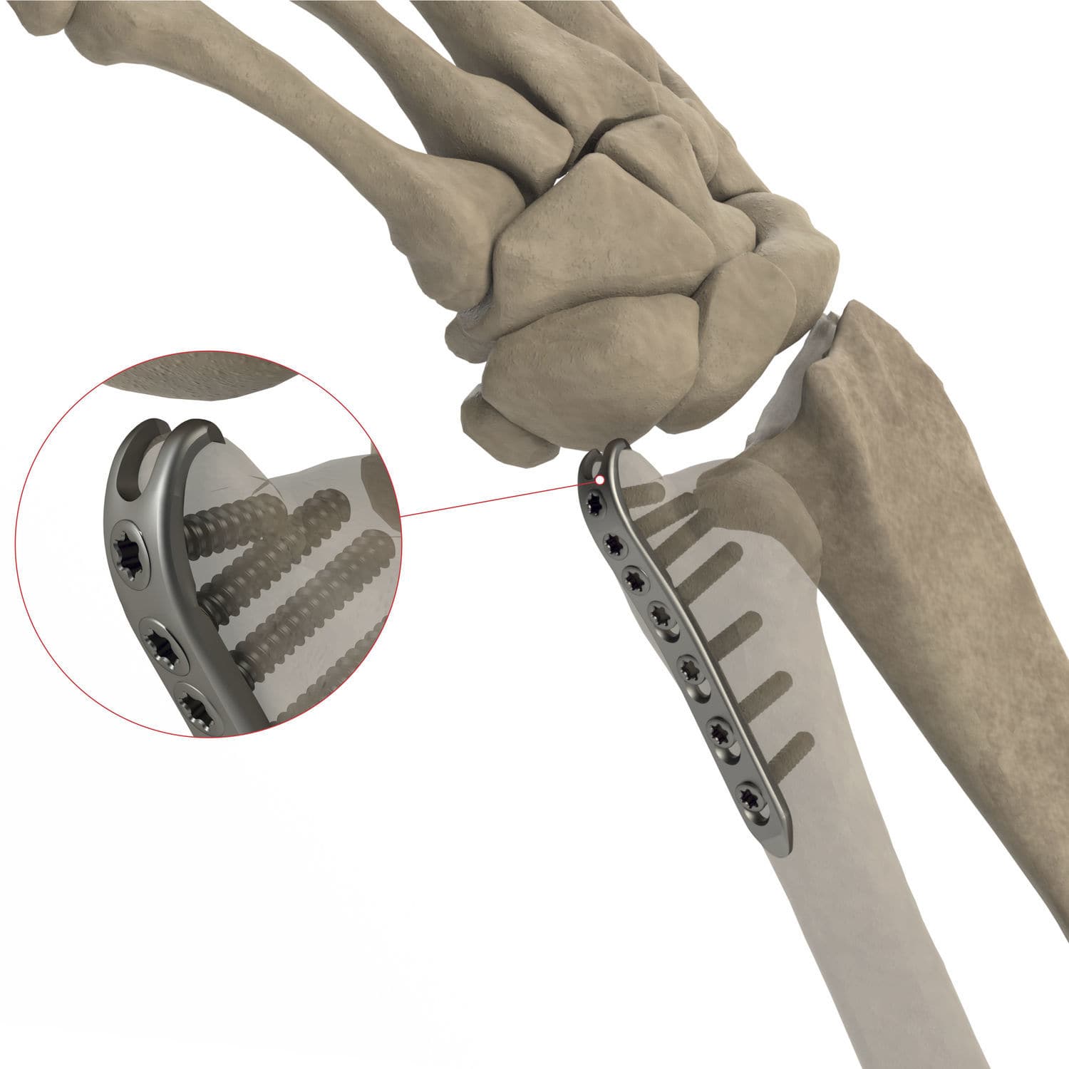 Ulna compression plate - AS.W.016 - Ases Orthopedics - distal / locking ...