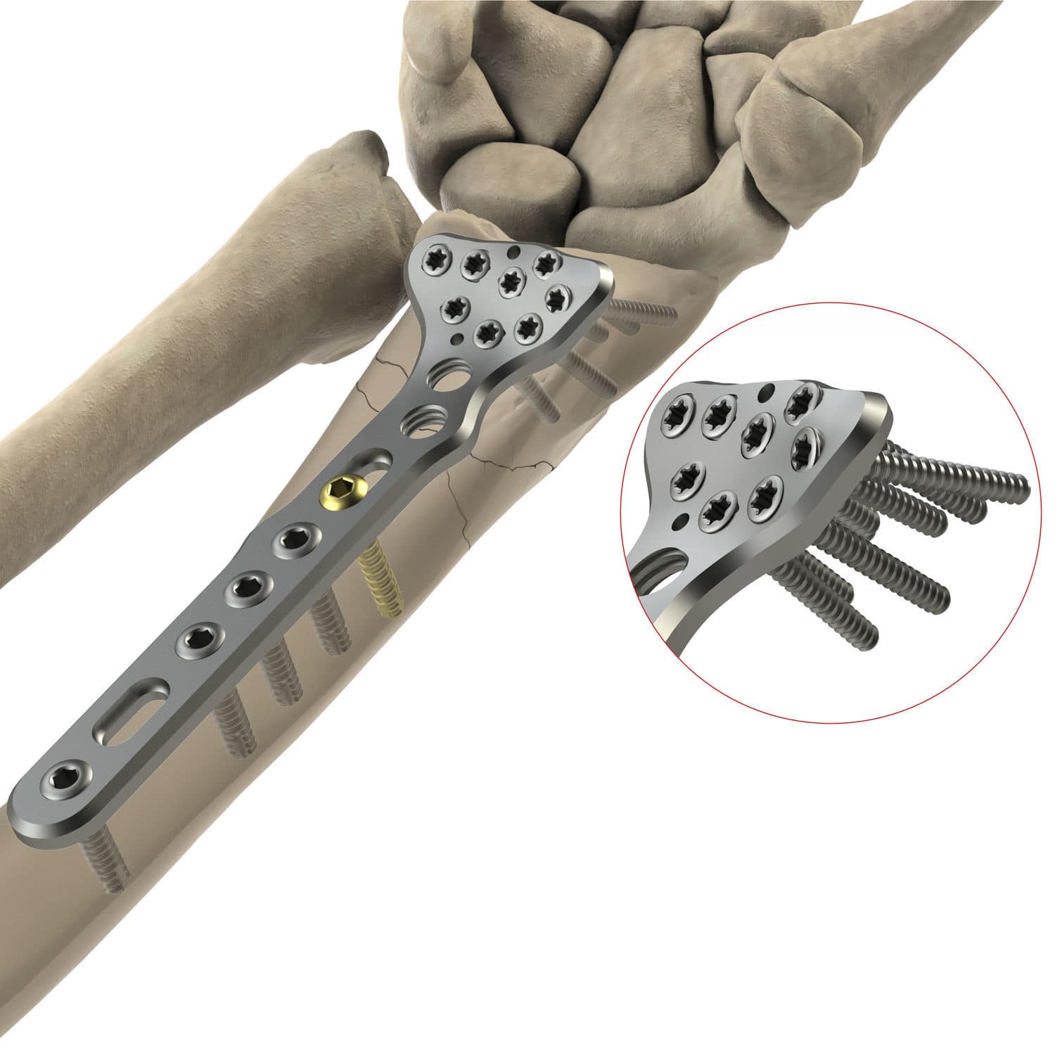 Radius compression plate - DR Volar II - Ases Orthopedics - distal ...