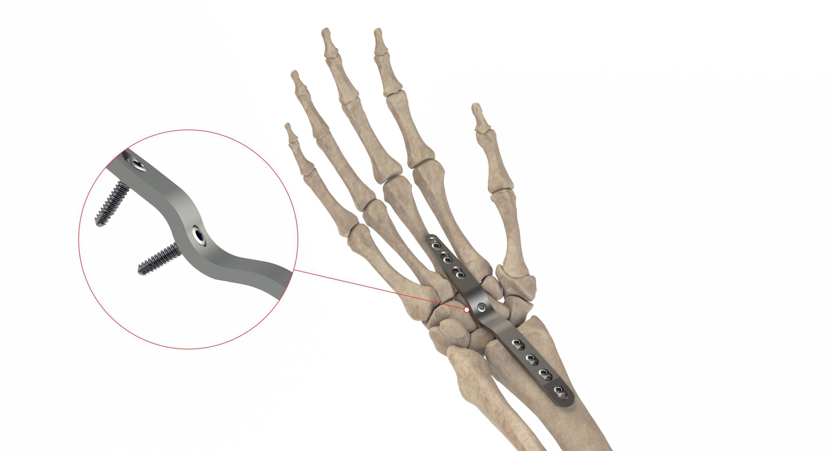 Carpal compression plate - HC Artrodesis LP - Ases Orthopedics - locking