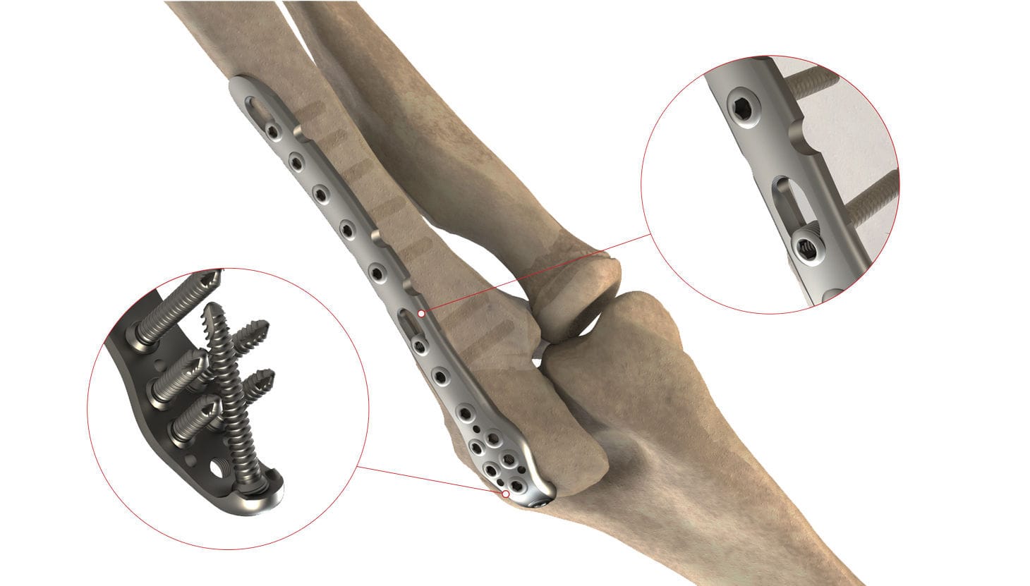 Ulna compression plate - Ases Orthopedics - proximal / locking