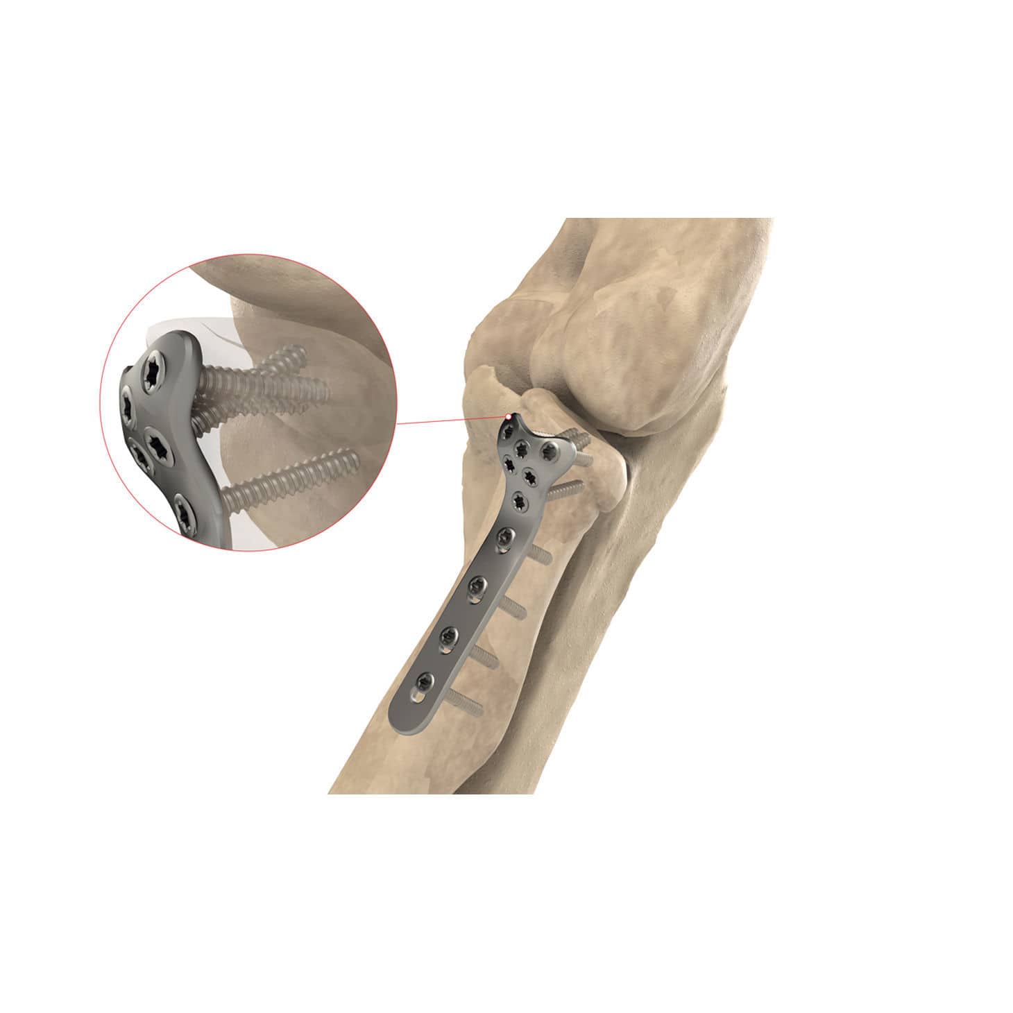 Radius compression plate - Ases Orthopedics - locking