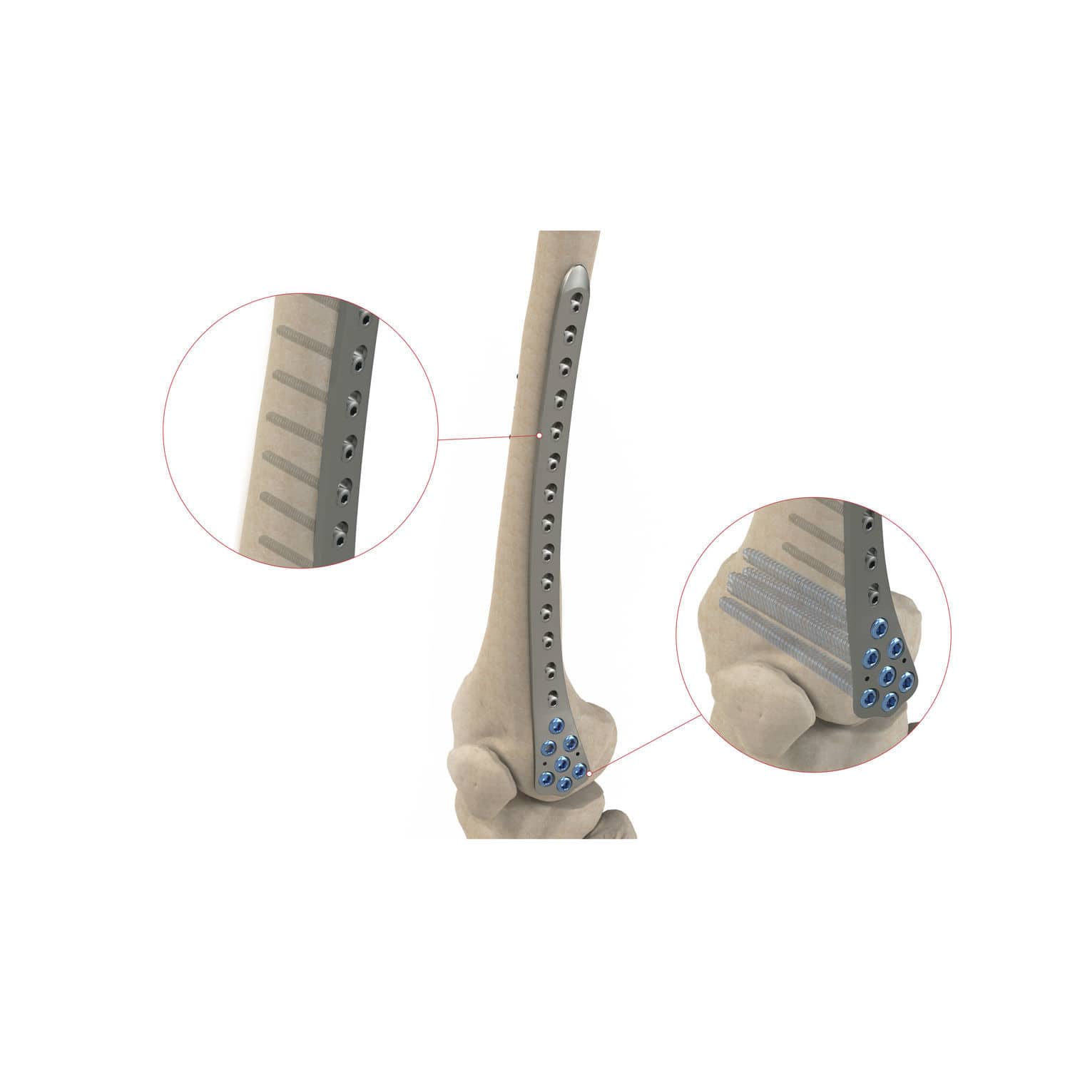 Femoral condyle compression plate - Ases Orthopedics - distal / locking