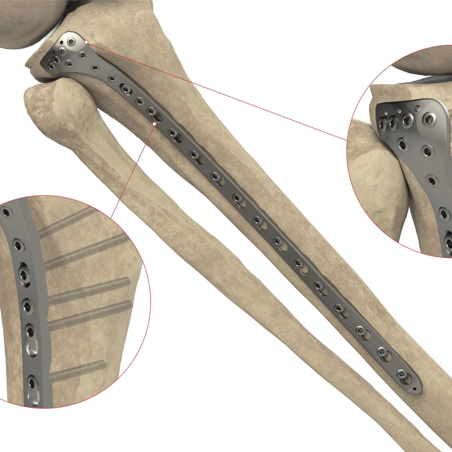 Tibia compression plate - Ases Orthopedics - proximal / lateral / locking