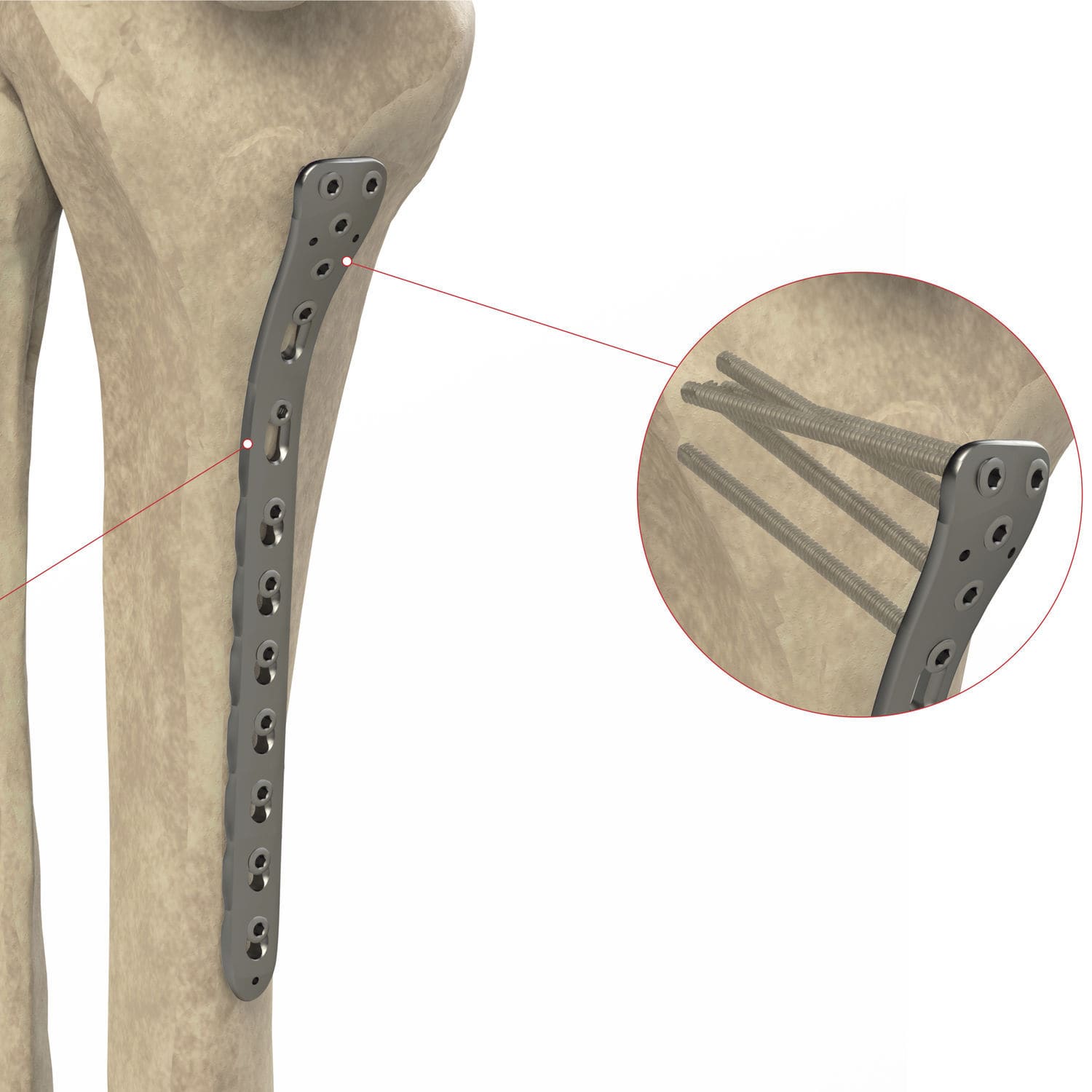 Tibia compression plate - Ases Orthopedics - proximal / medial
