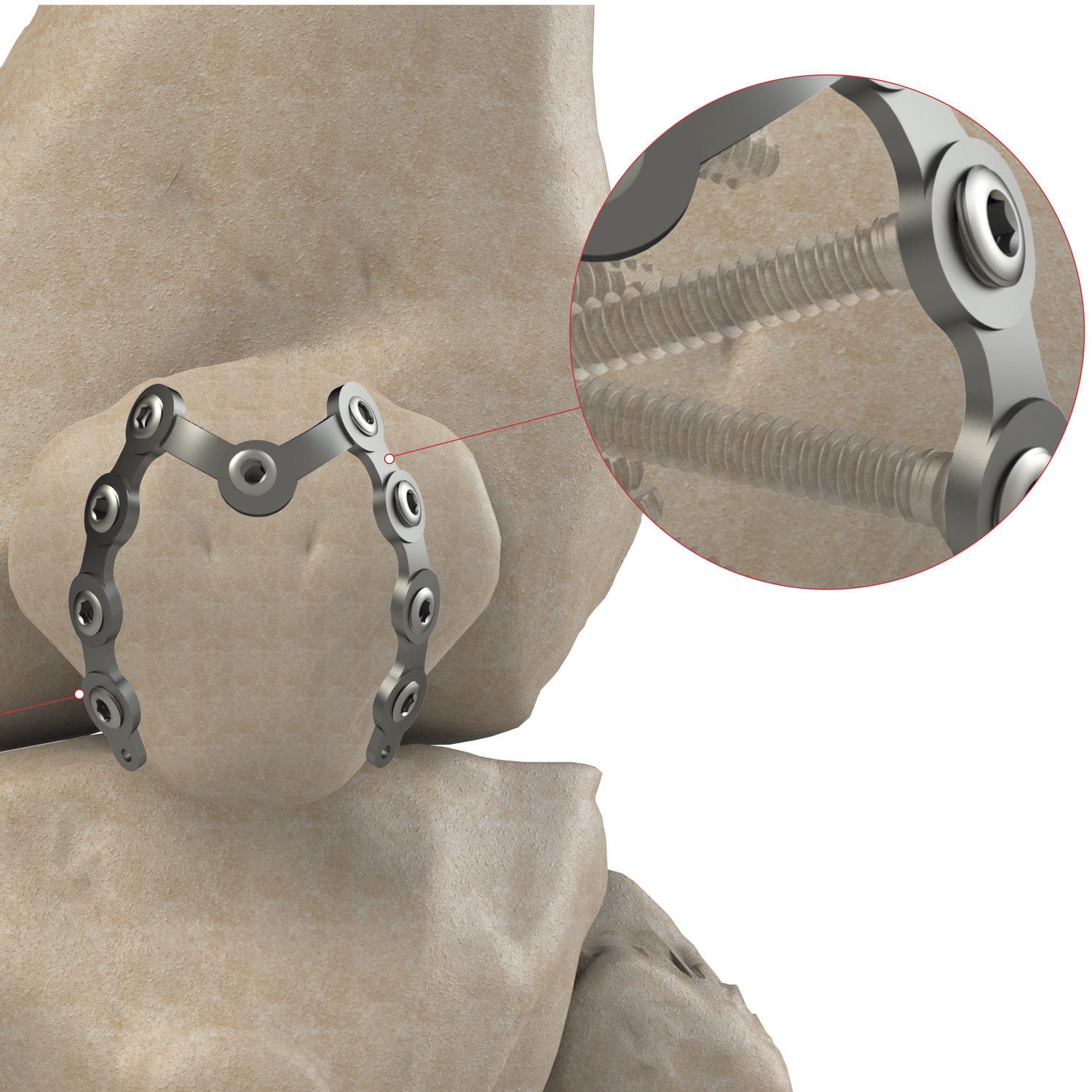 Patella compression plate - Ases Orthopedics - locking