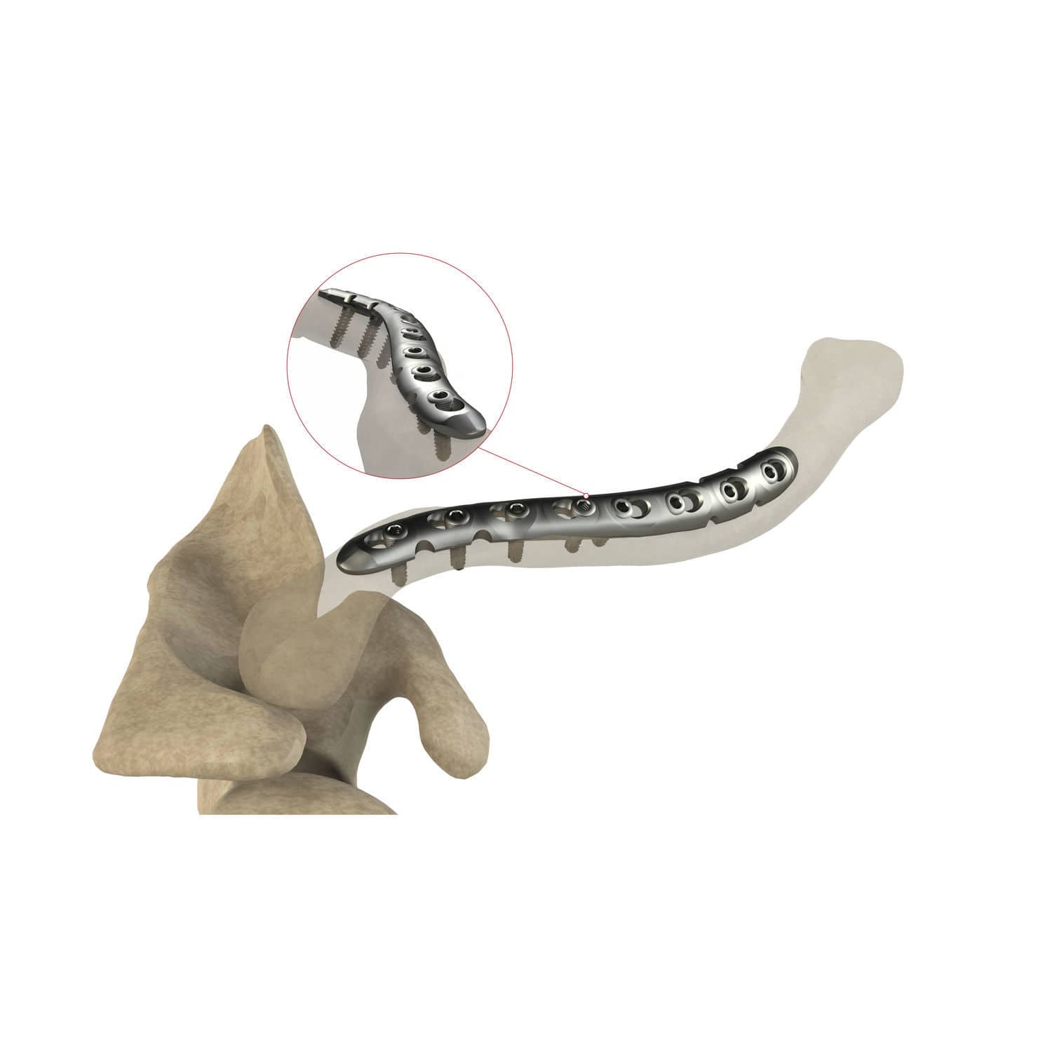 Clavicle compression plate - Ases Orthopedics