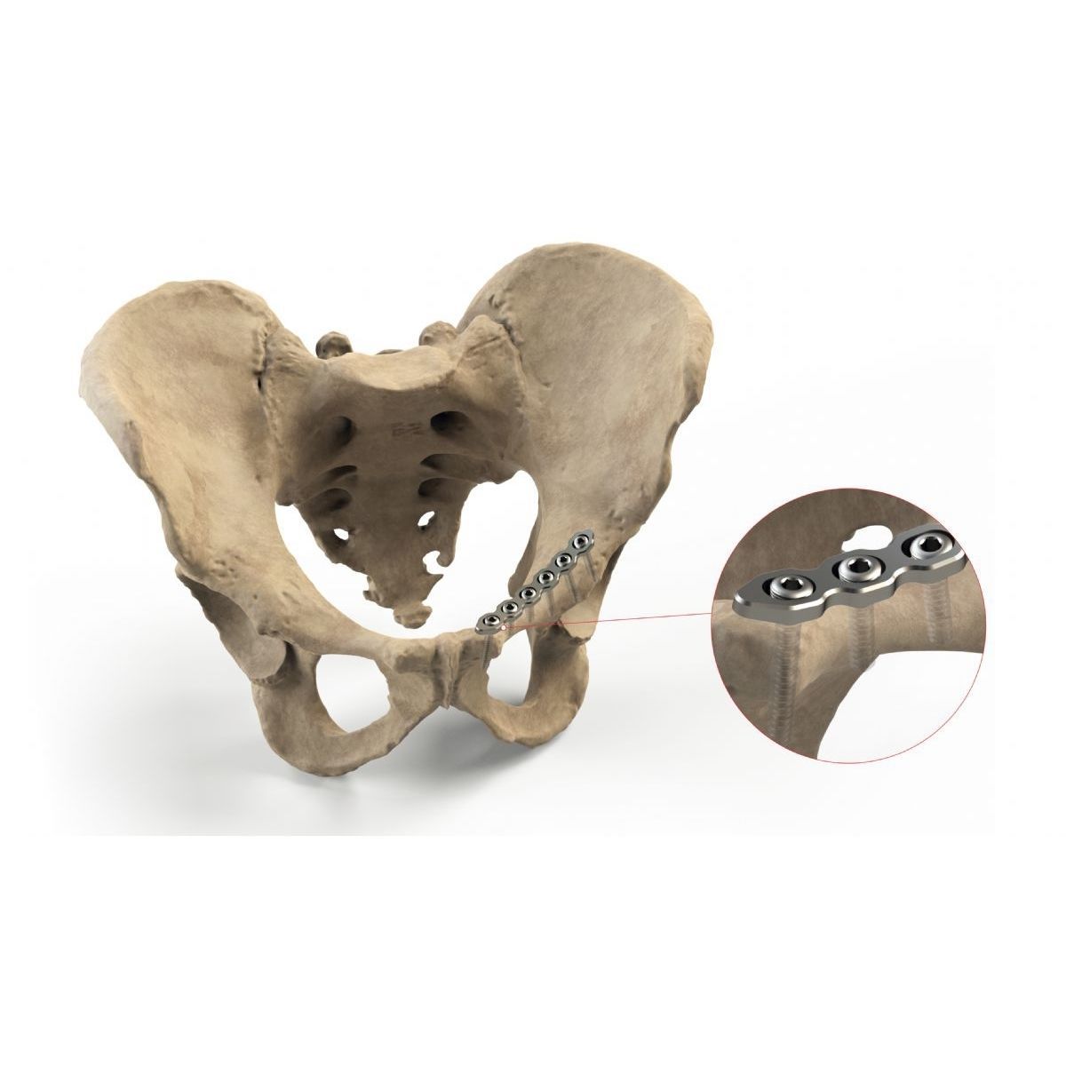 Pelvis compression plate - Ases Orthopedics - locking