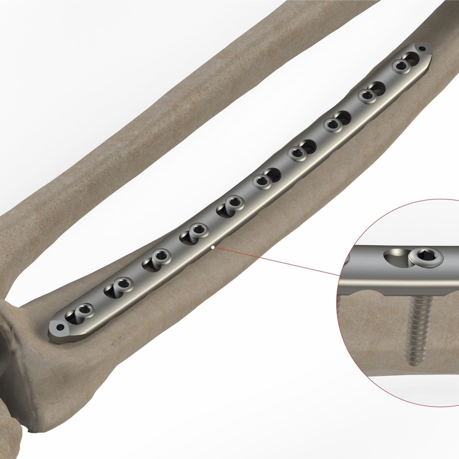 Radius compression plate - 1T12 series - Ases Orthopedics - distal ...