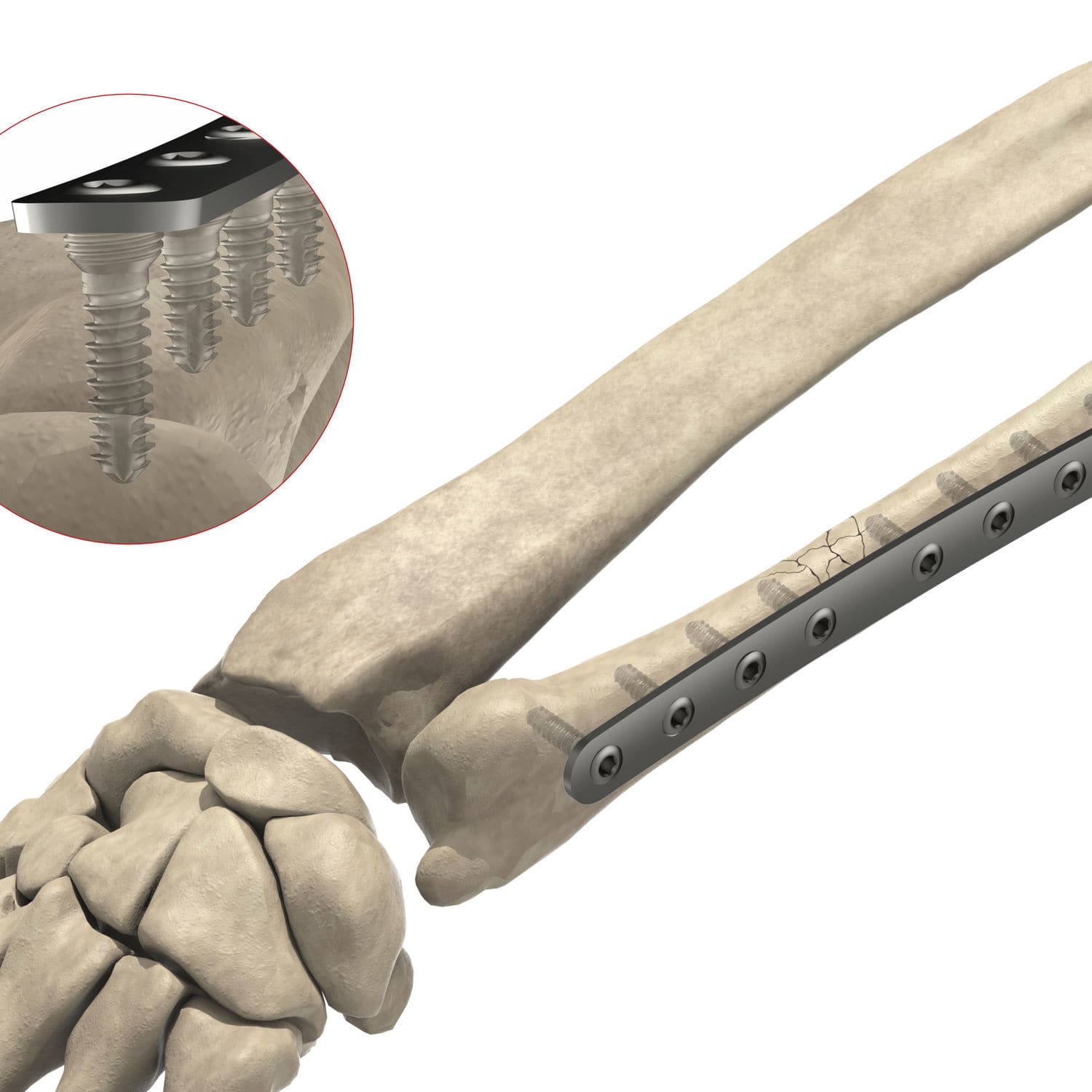 Ulna compression plate - 1T12-06404 - Ases Orthopedics - distal / locking