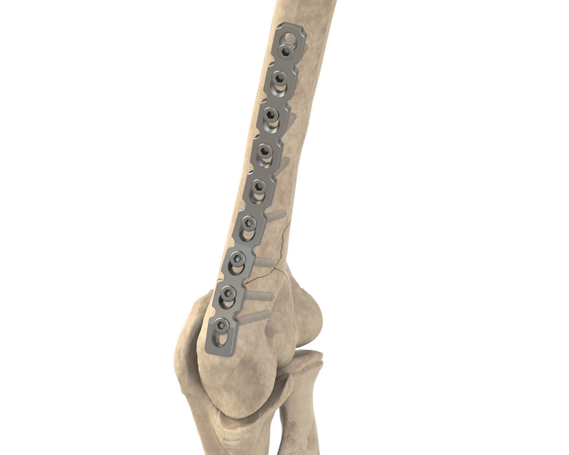 Humeral compression plate - 1T12-04104 - Ases Orthopedics - distal ...